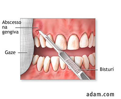 Patologia em ação: Abscesso