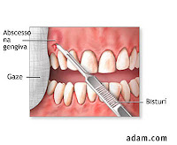 Patologia em ação: Abscesso