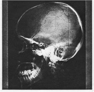 Twis's Blog: Teknik Radiografi Skull (Proyeksi Lateral)