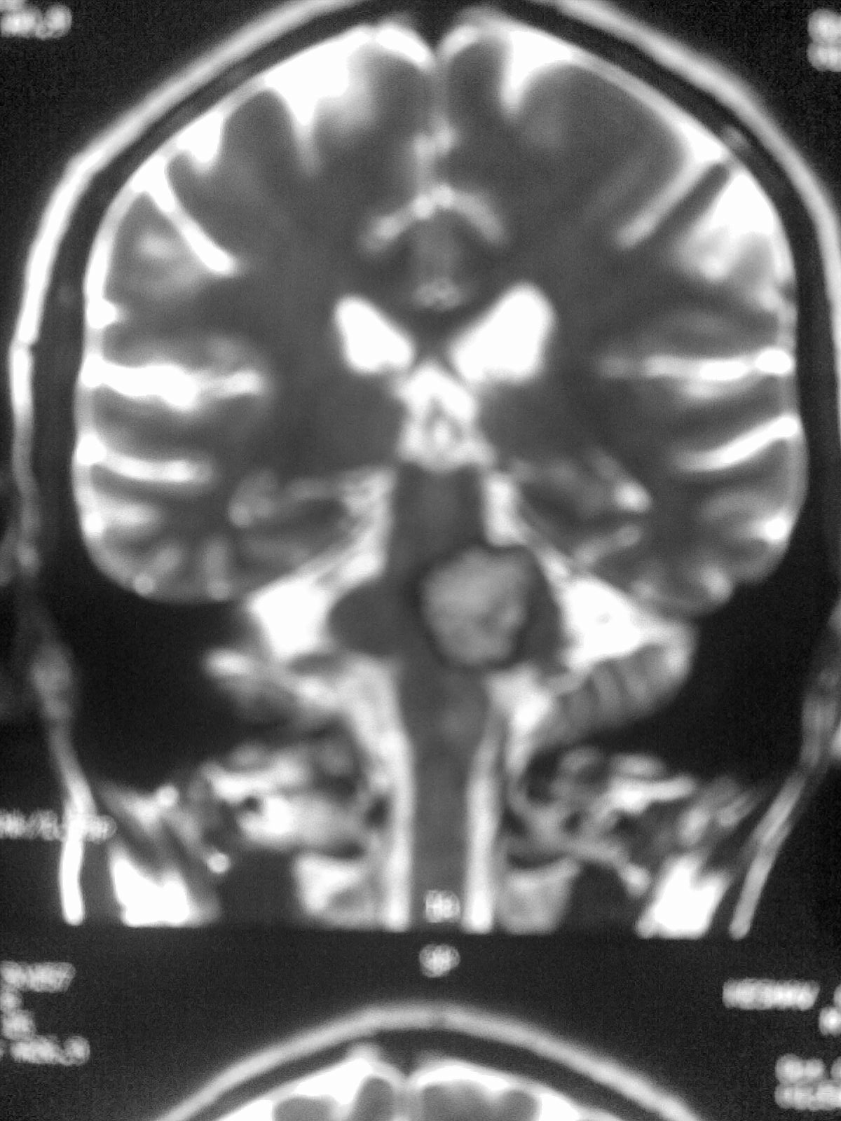 Hypertrophic Inferior Olivary degeneration due to brainstem cavernoma ...