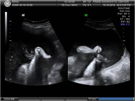 Prime Fetal Medicine: 24 Weeks of Gestation (Trisomy-18)