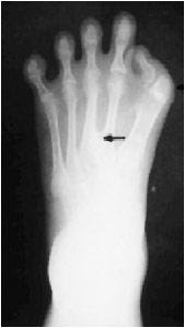 Kaitlynn's Place: Fibrodysplasia Ossificans Progressiva (FOP)