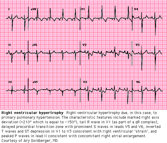 Dr. Amir's Blog: Thumb method for QRS axis determination