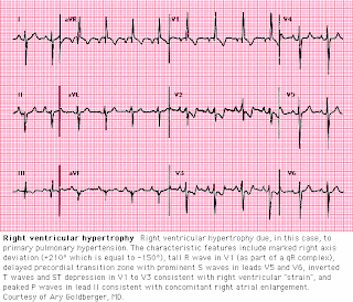Dr. Amir's Blog: Thumb method for QRS axis determination