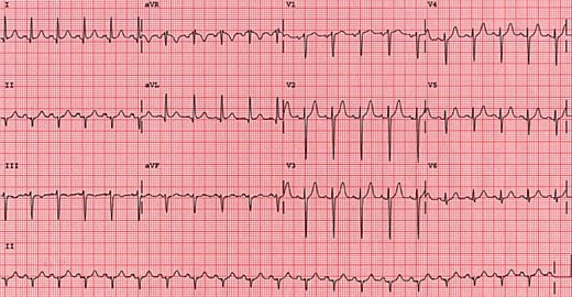 Dr. Amir's Blog: Thumb method for QRS axis determination