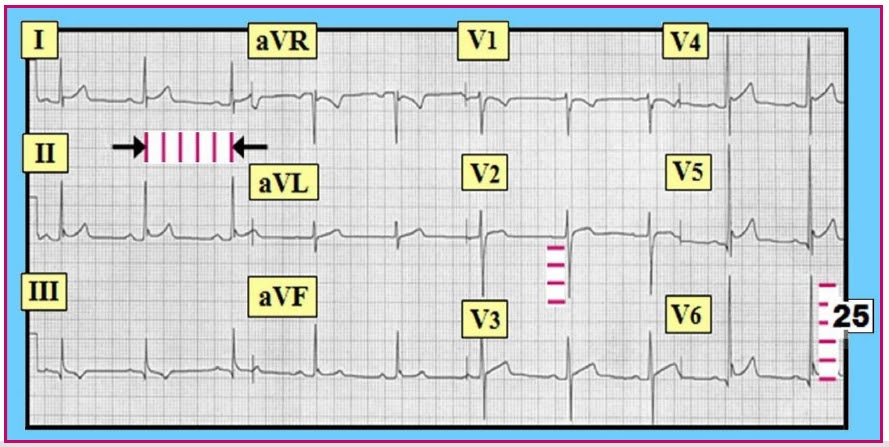ECG Interpretation: ECG Interpretation Review - #2 ("Smiley" ST, ST ...