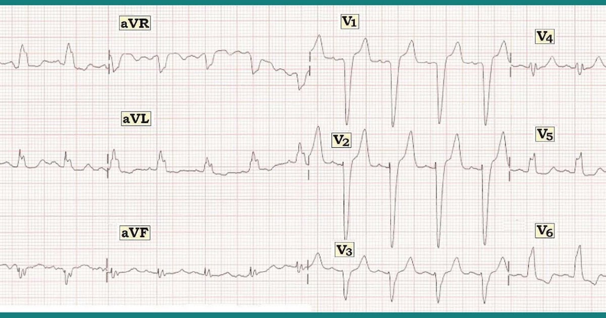 ECG Interpretation: ECG Interpretation Review #11 (BBB, Wide QRS, ST ...