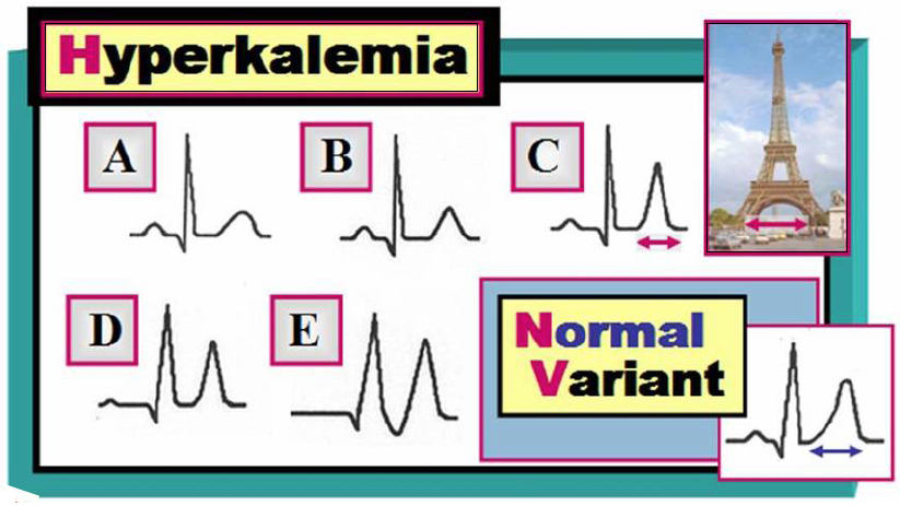 ECG Interpretation: ECG Interpretation Review #10 (Peaked T Waves ...