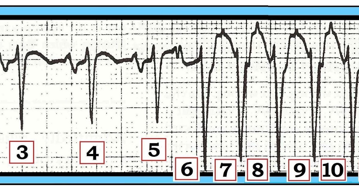 ECG Interpretation: ECG Interpretation Review #15 (Run of WCT - VT vs ...