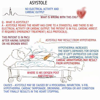 Dear Nurses: WHAT IS WRONG WITH THIS EKG - ASYSTOLE