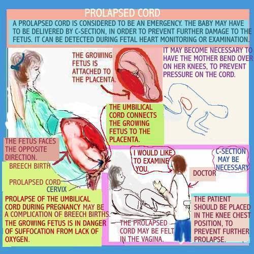 Knee Chest Position For Prolapsed Cord