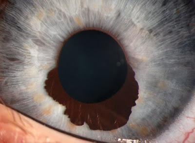 PhotoStorrey: Iris Nevus