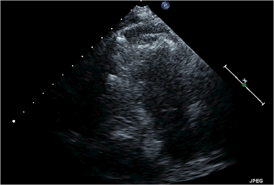 CVT Mohd Farid: Basic Echo Window :Parasternal Long Axis View :RV Outflow