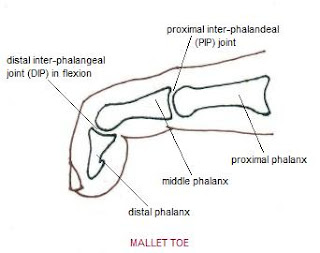 Foot Relief: Mallet Toe