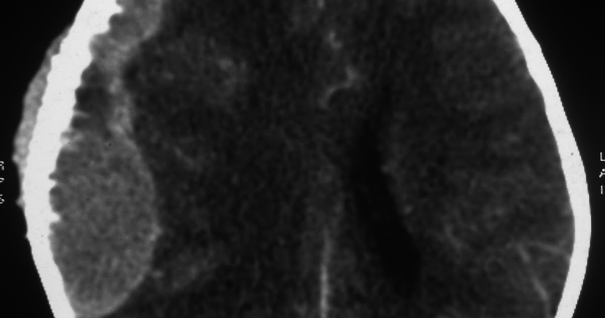 Radiodiagnosis Imaging Is Amazing Interesting Cases Primitive Neuroectodermal Tumor Pnet Of