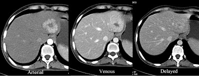 Radiodiagnosis - Imaging is Amazing-Interesting cases: Focal Nodular ...