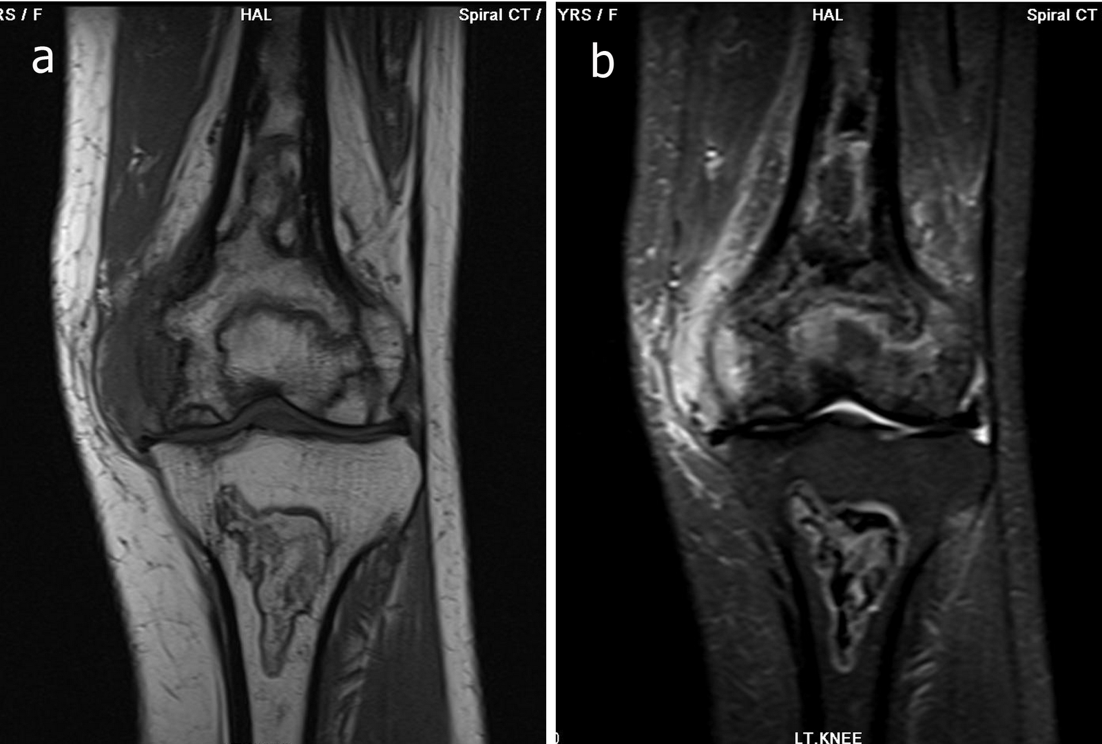 Radiodiagnosis - Imaging is Amazing-Interesting cases: Bone infarct - MRI