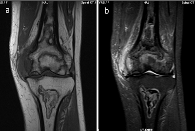 Radiodiagnosis - Imaging is Amazing-Interesting cases: Bone infarct - MRI