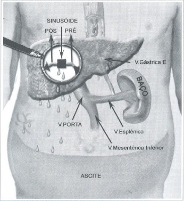 Ascite: Fisiopatologia