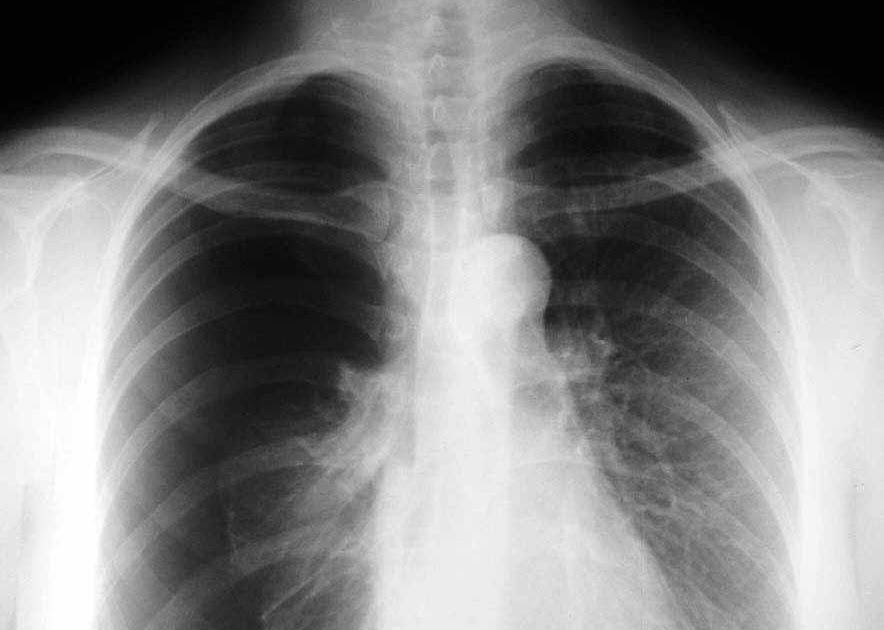 Endoscopia Ginecologica: Neumotorax Catamenial