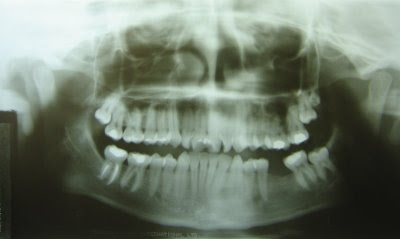 "Te vejo por dentro": Dente supranumerário