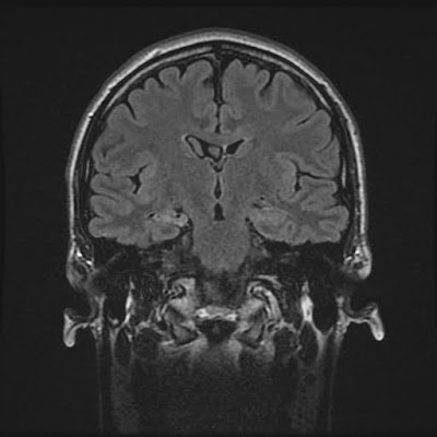 Radiology Cases: Mesial Temporal Sclerosis