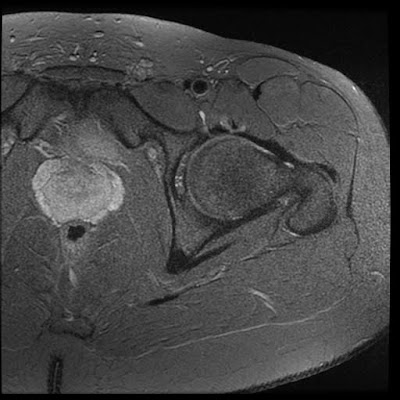 Radiology Cases: Snapping Hip Syndrome