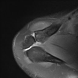 Radiology Cases: Meso Os Acromiale
