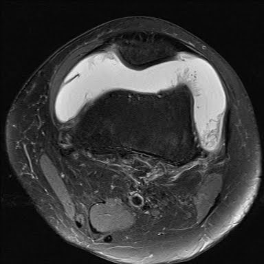 Radiology Cases: Synovial Hypertrophy
