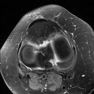 Radiology Cases: Radial Tear Posterior Medial Meniscal Root