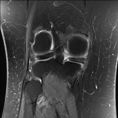 Radiology Cases: Radial Tear Posterior Medial Meniscal Root