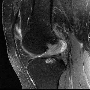 Radiology Cases: Mucoid Degeneration ACL with extraligamentous and ...