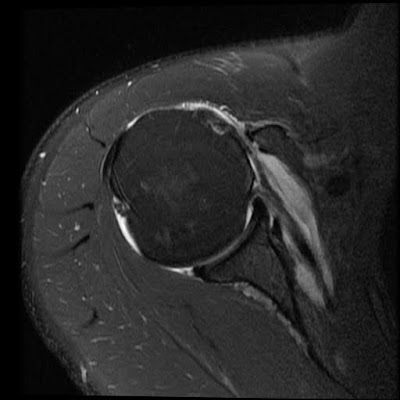 Radiology Cases: Subcoracoid Impingement and Subscapularis Tear