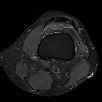 Radiology Cases: Quadriceps/Suprapatella Fat Pad impingement