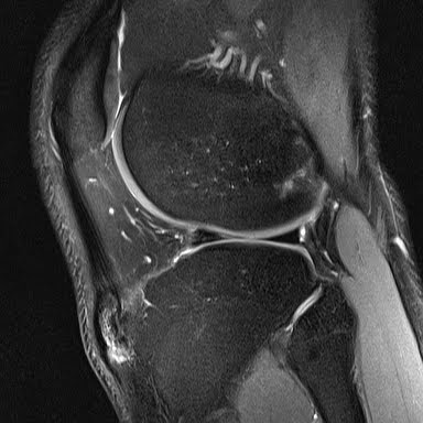 Radiology Cases: Parrot Beak Tear = Non displaced flap tear