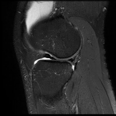 Radiology Cases: Double Delta Sign and Deep Lateral Sulcus Sign