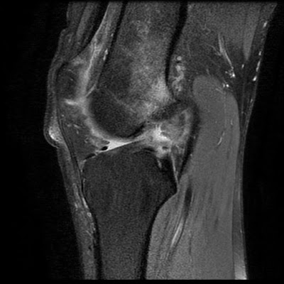 Radiology Cases: ACL Rupture and Grade III MCL Tear