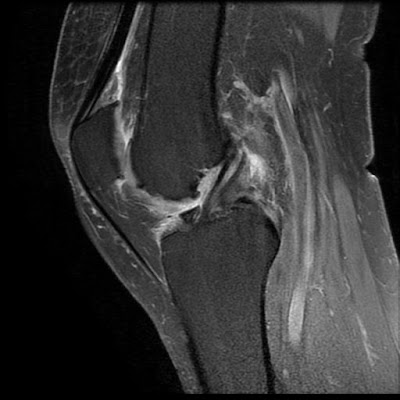 Radiology Cases: ACL - Chronic Interstitial Tear