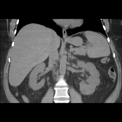 Radiology Cases: Multifocal Acute Pyelonephritis