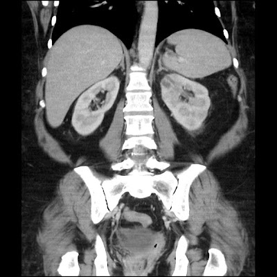 Radiology Cases: Multifocal Acute Pyelonephritis