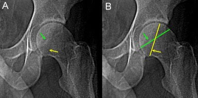 Radiology Cases: Acetabular Retroversion