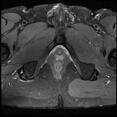 Radiology Cases: Hamstring Tendinopathy and PT tear, Osteitis Pubis and ...