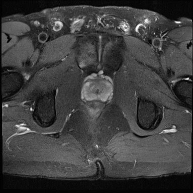 Radiology Cases: Hamstring Tendinopathy and PT tear, Osteitis Pubis and ...