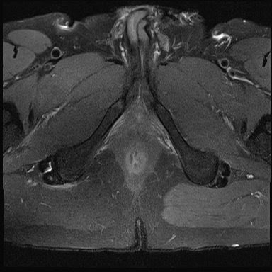 Radiology Cases: Hamstring Tendinopathy and PT tear, Osteitis Pubis and ...