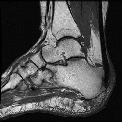 Radiology Cases: Haglund's Syndrome