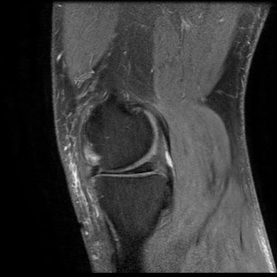 Radiology Cases: Meniscal Radial Tear