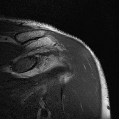 Radiology Cases: Rotator Interval Tear