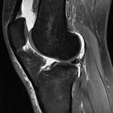 Radiology Cases: ACL Tear and Wrisberg Rip