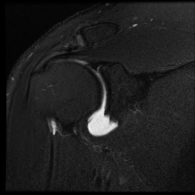 Radiology Cases: SLAP V