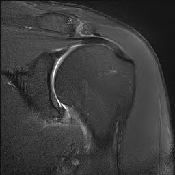 Radiology Cases: Adhesive Capsulitis